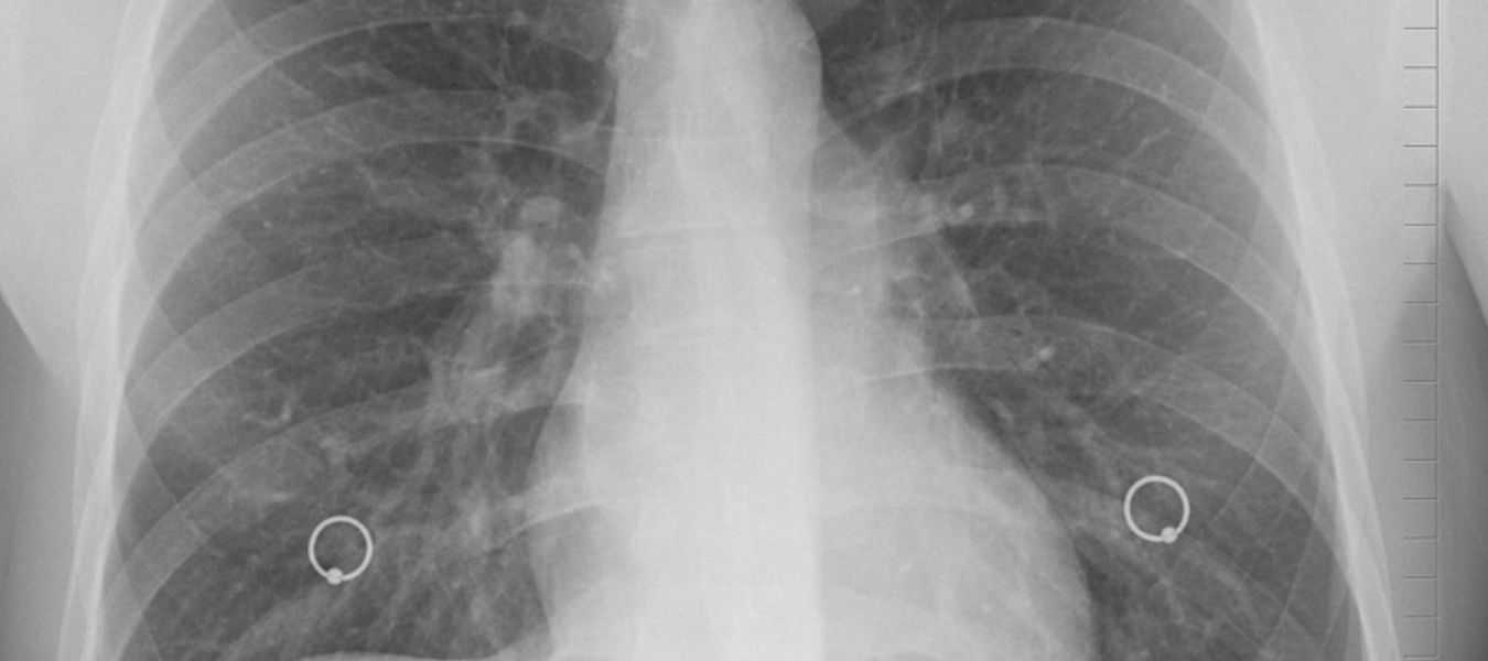 Descubren un tratamiento que reduce el cáncer de pulmón en 80 % de ...